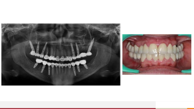 The Tall Tilted Pin Hole Placement Immediate Loading.pptx