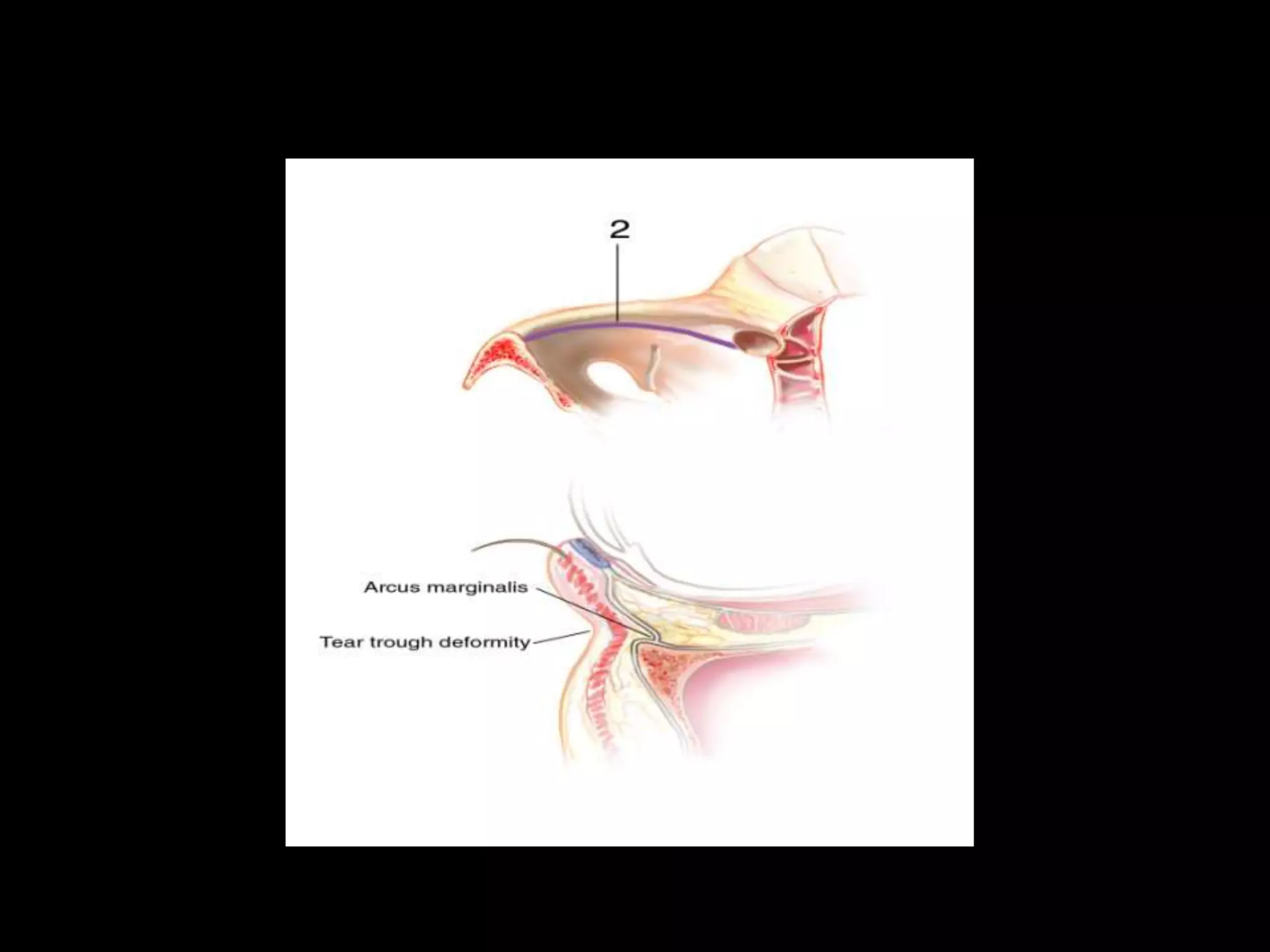 The Tear Trough Deformity | PPTX