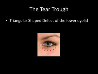 The Tear Trough Deformity | PPT | Free Download