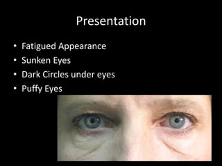 The Tear Trough Deformity | PPTX