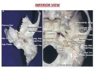 The temporal bone and transtemporal approaches | PPT