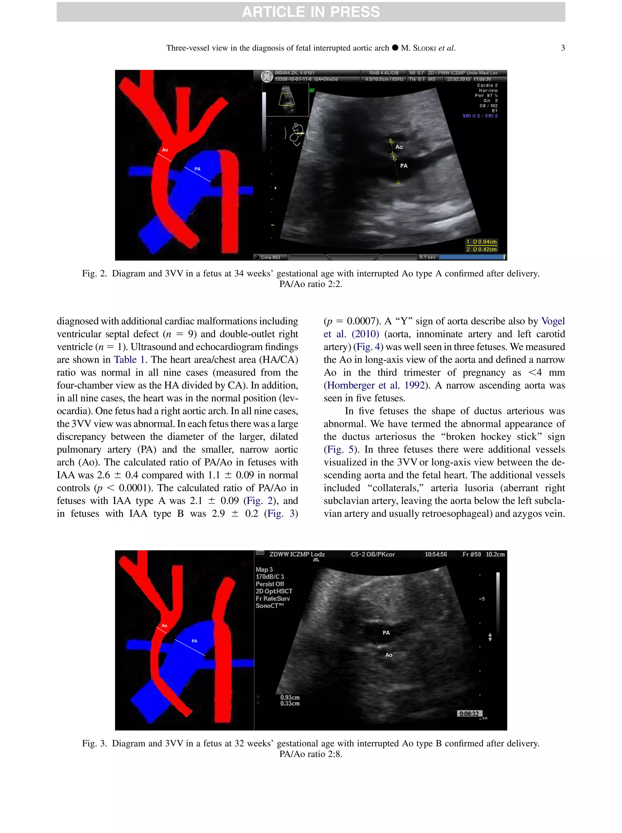 The three vessel view in the fetal mediastinum in the diagnosis | PDF