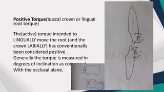 THE THREE ORDER BENDS in STANDARD EDGEWISE TECHNIQUE.pptx