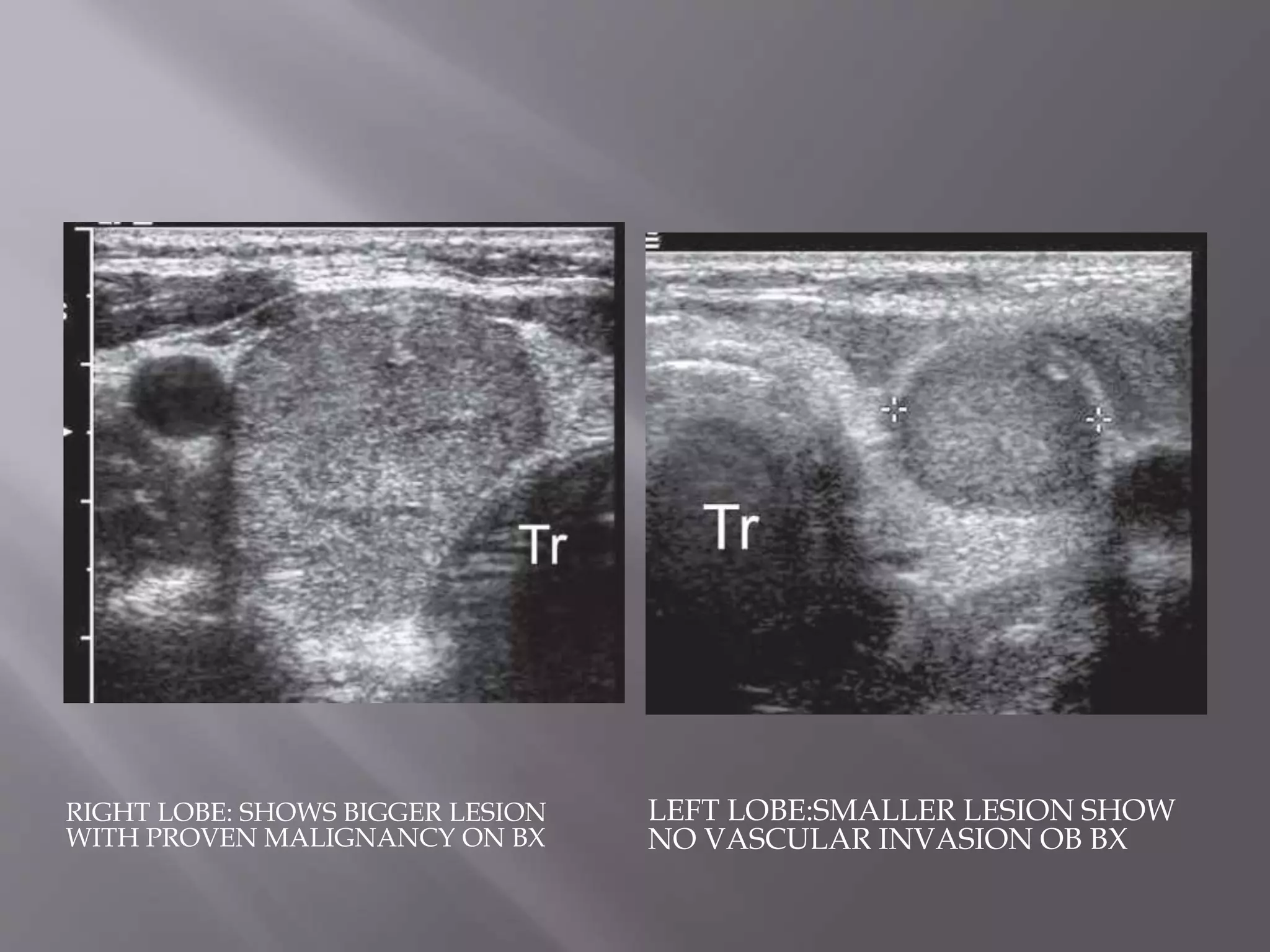 The thyroid gland | PPTX