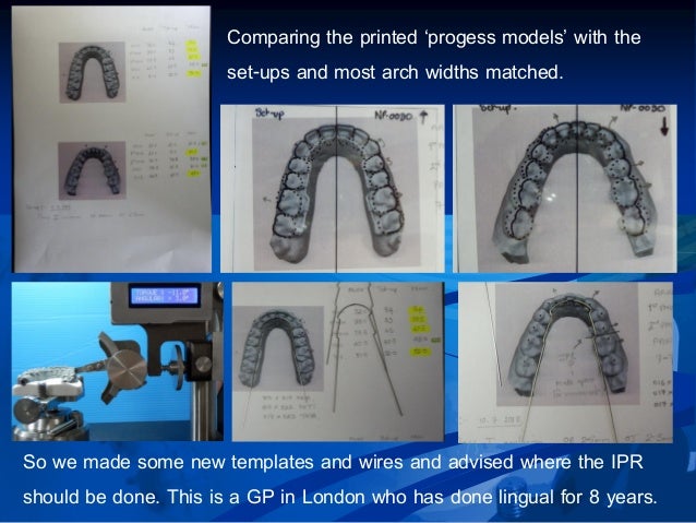 Lingual and Labial Orthodontic Indirct Bonding Services