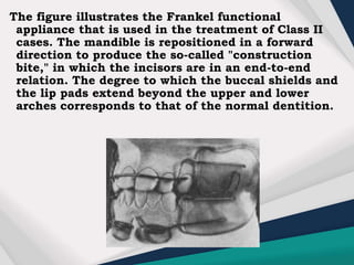 THE TREATMENT OF CLASS II, DIVISION 1 MALOCCLUSION WITH FUNCTIONAL ...