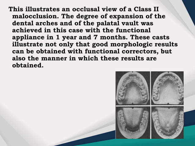 THE TREATMENT OF CLASS II, DIVISION 1 MALOCCLUSION WITH FUNCTIONAL ...