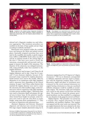 The use of angulated abutments in | PDF