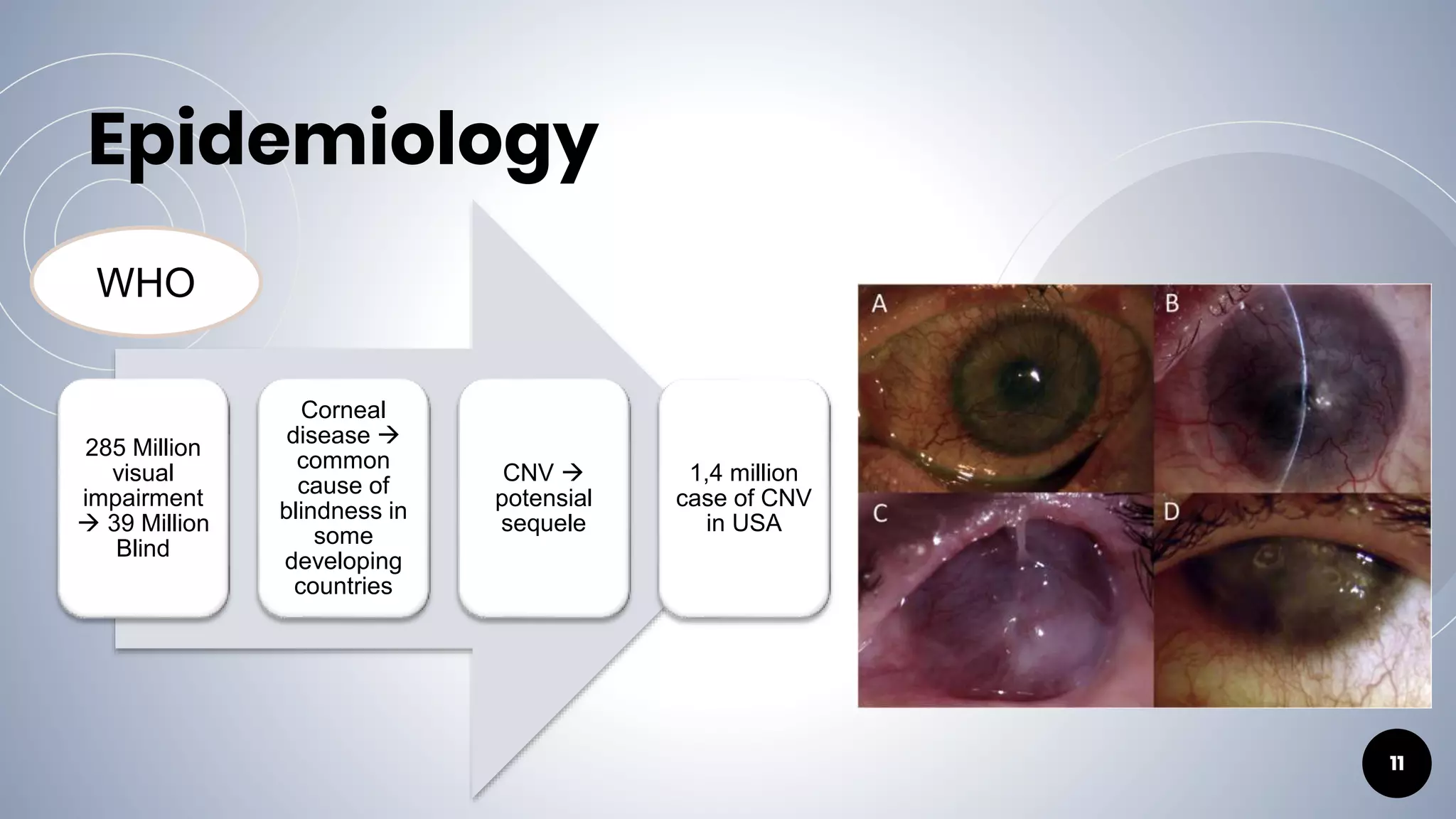 The use of anti vegf in corneal neovascularization | PPTX