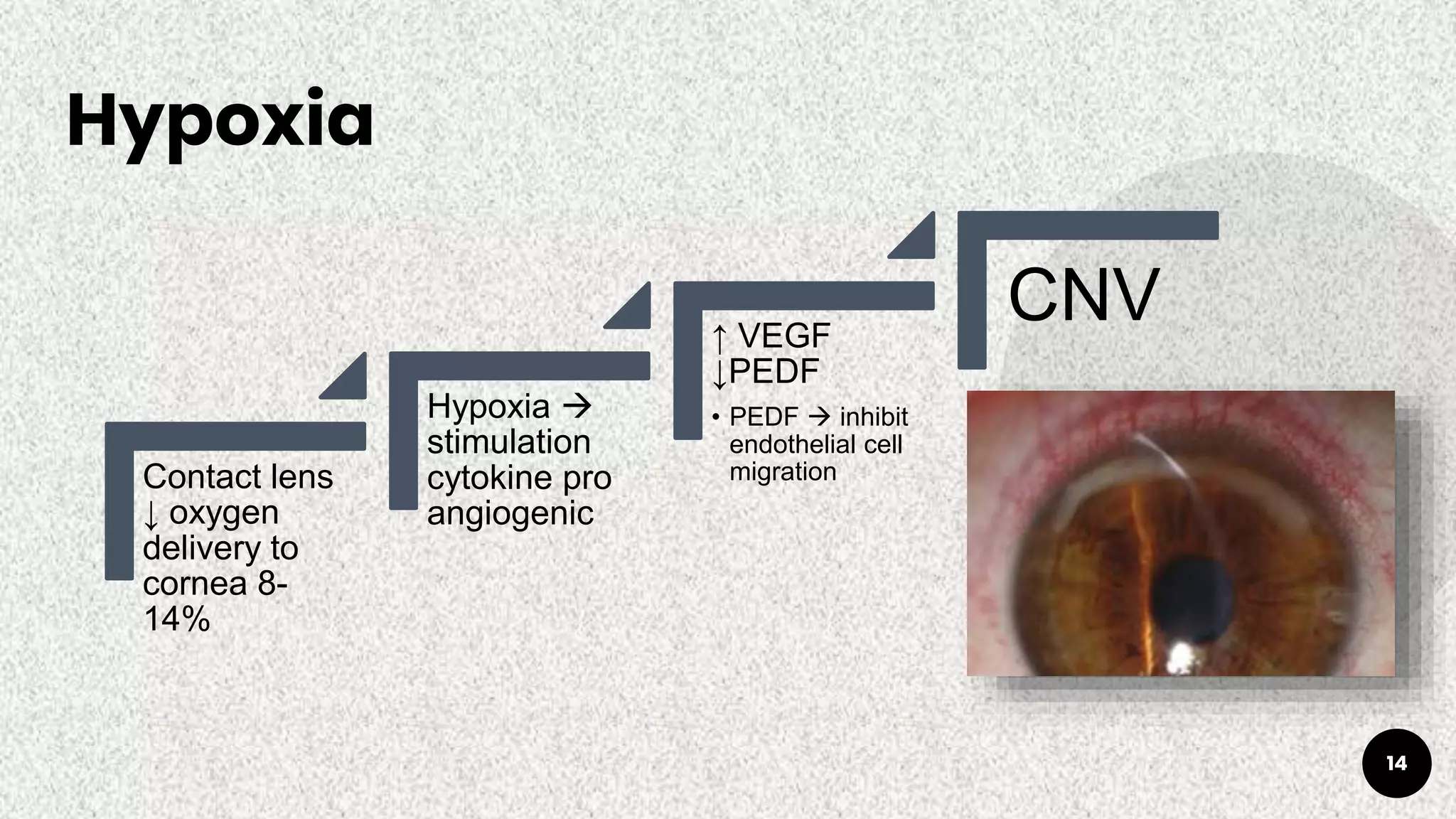 The use of anti vegf in corneal neovascularization | PPTX