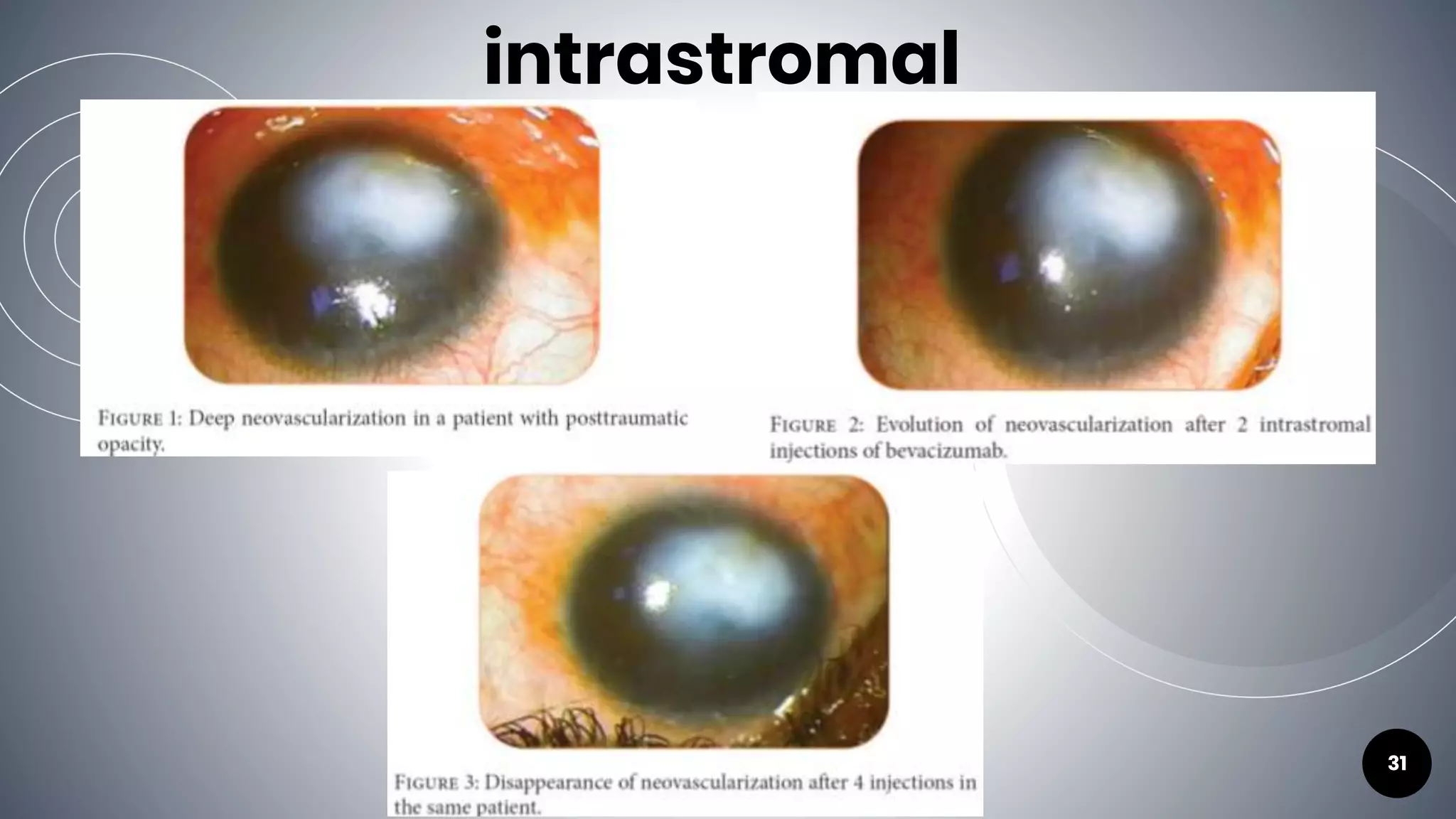 The use of anti vegf in corneal neovascularization | PPTX