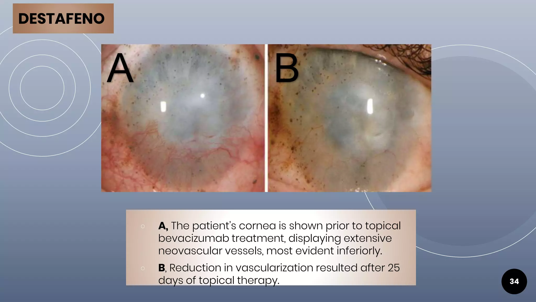 The use of anti vegf in corneal neovascularization | PPTX