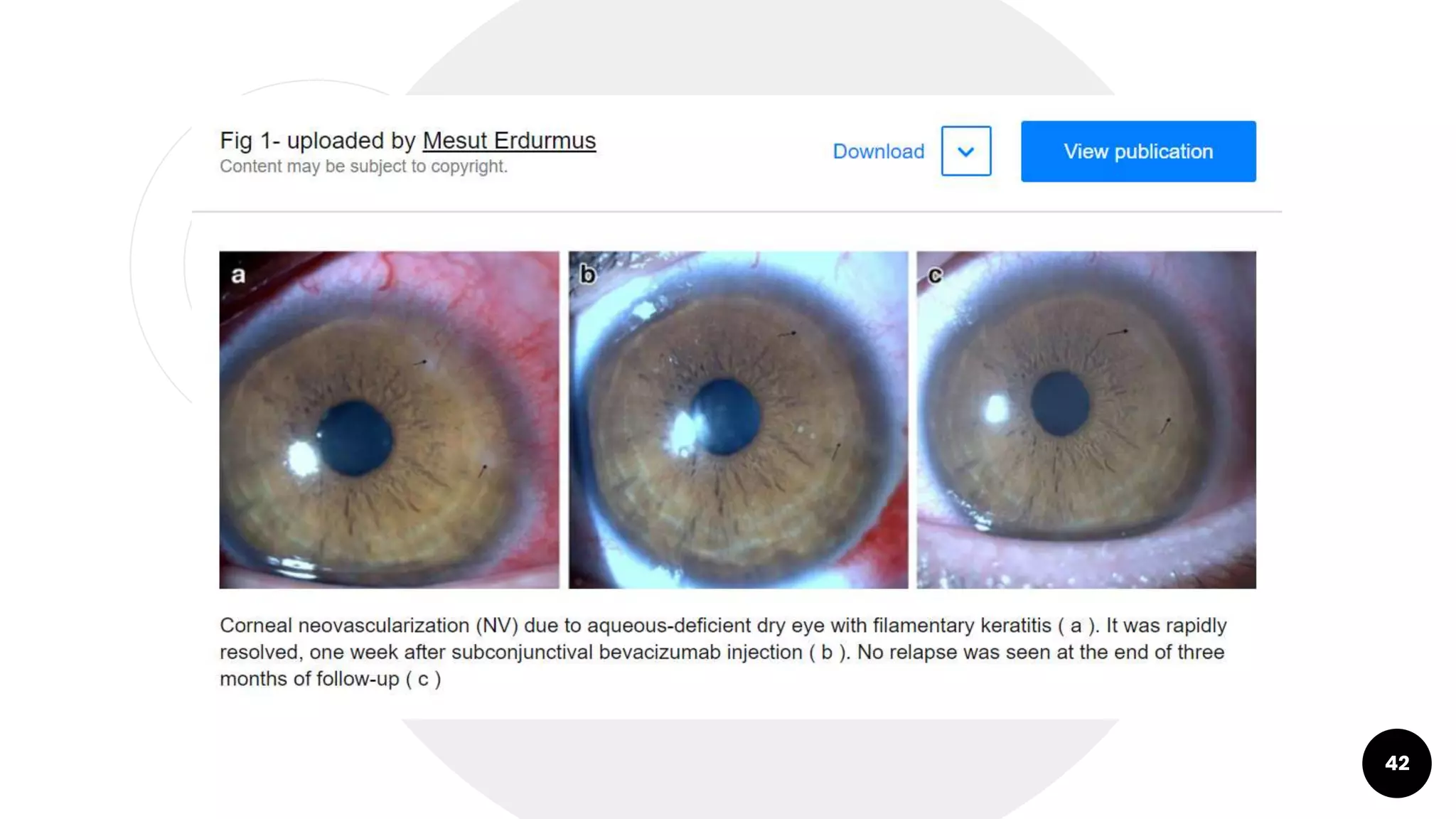 The use of anti vegf in corneal neovascularization | PPTX