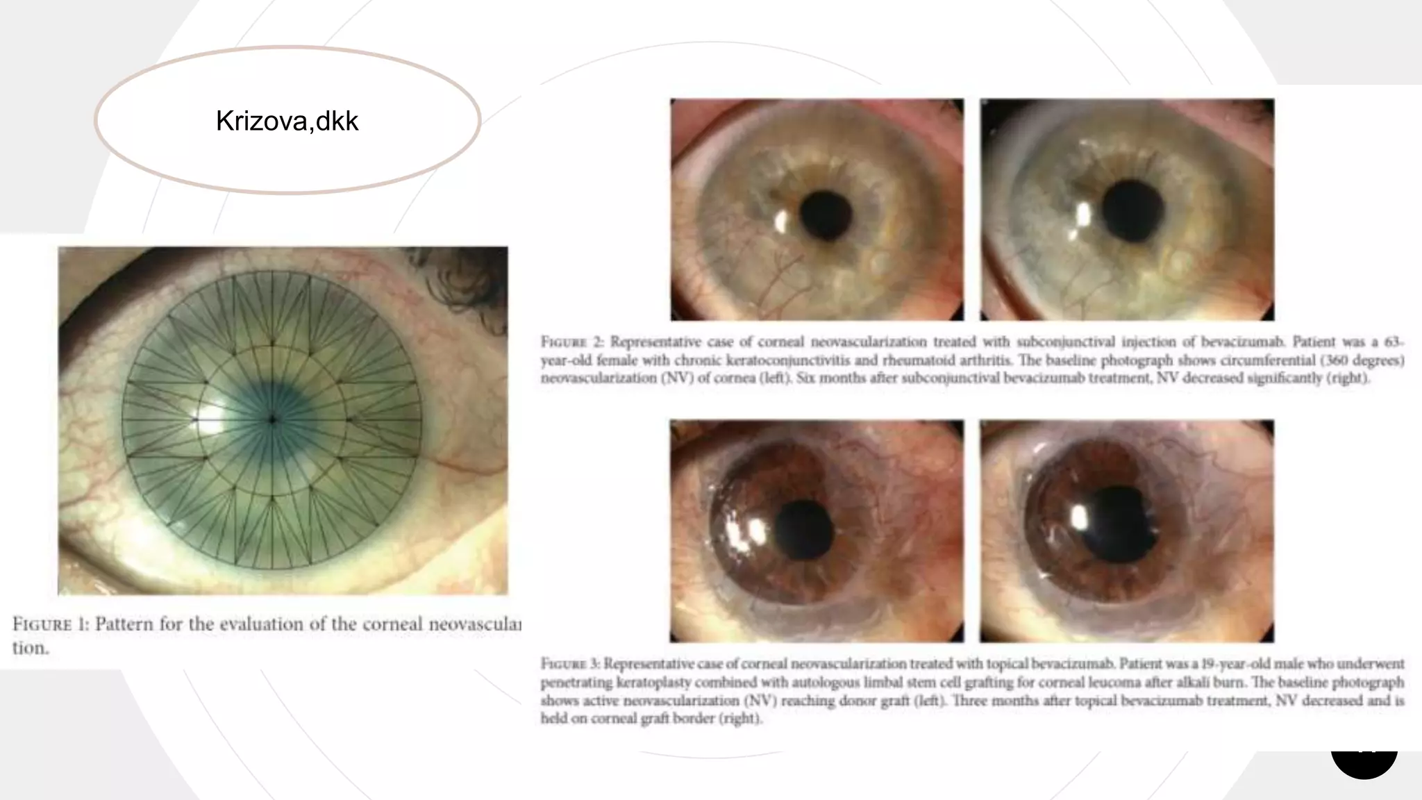 The use of anti vegf in corneal neovascularization | PPTX