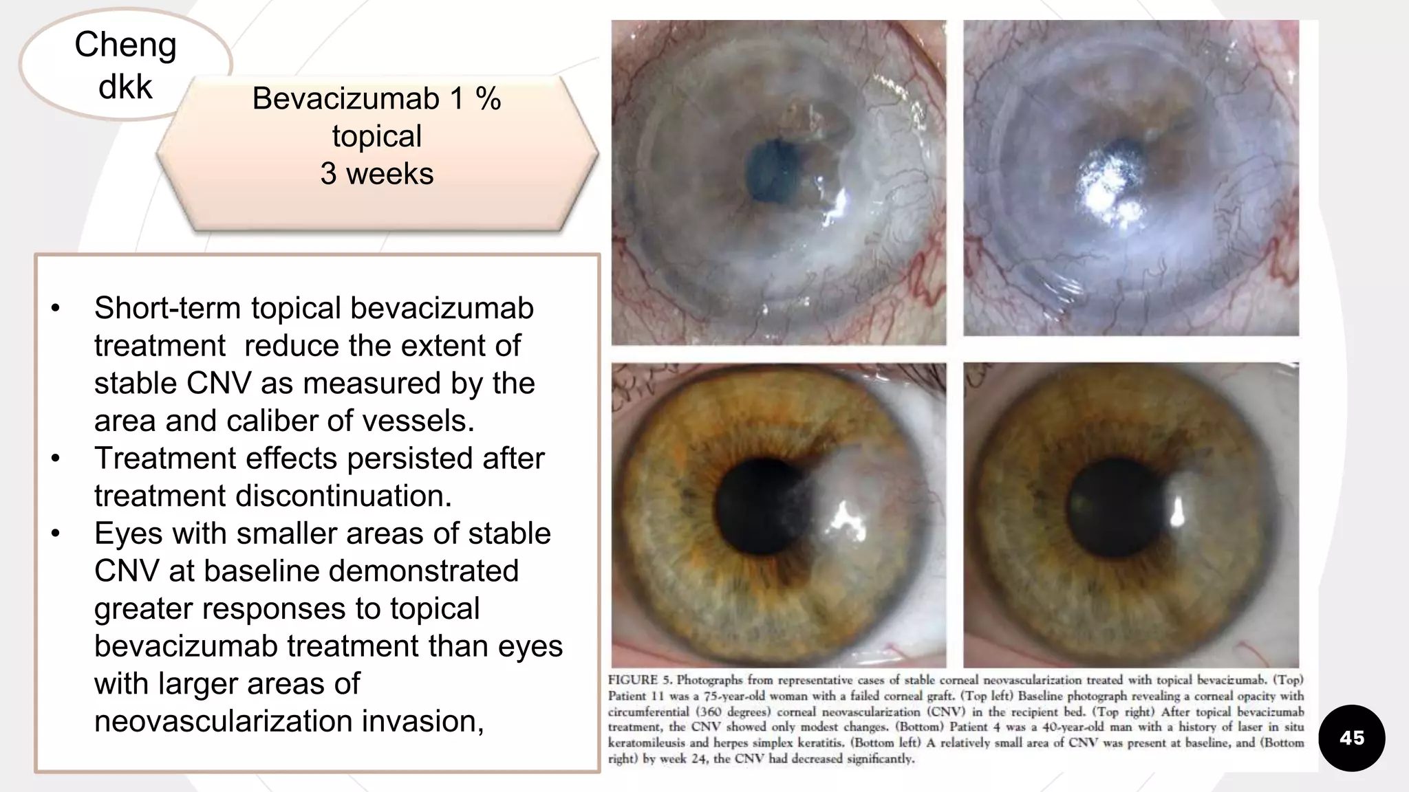 The use of anti vegf in corneal neovascularization | PPTX