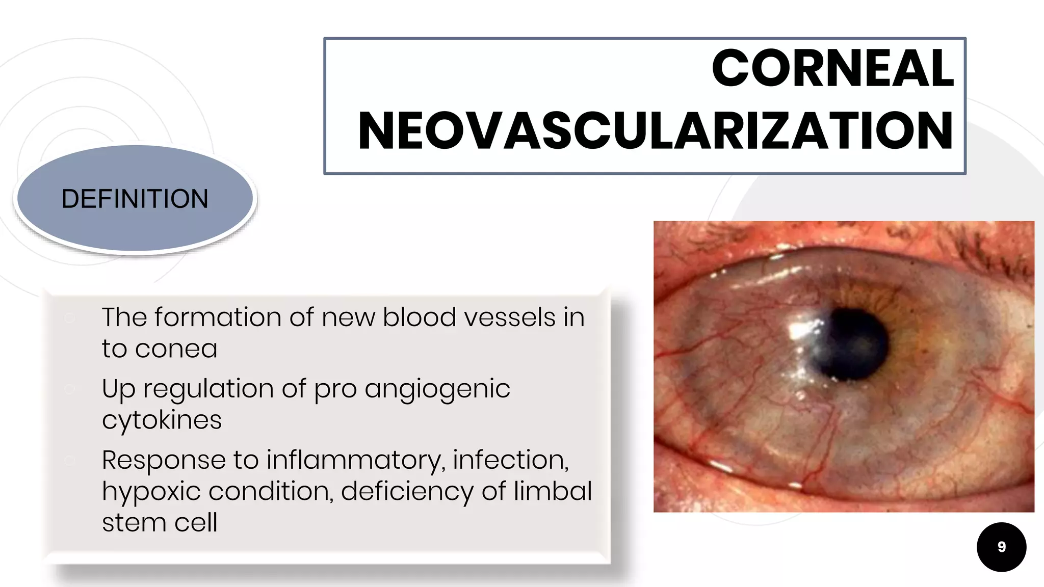 The use of anti vegf in corneal neovascularization | PPTX