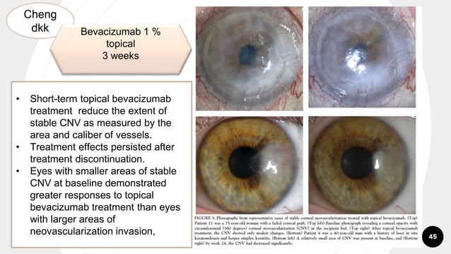 The use of anti vegf in corneal neovascularization | PPTX