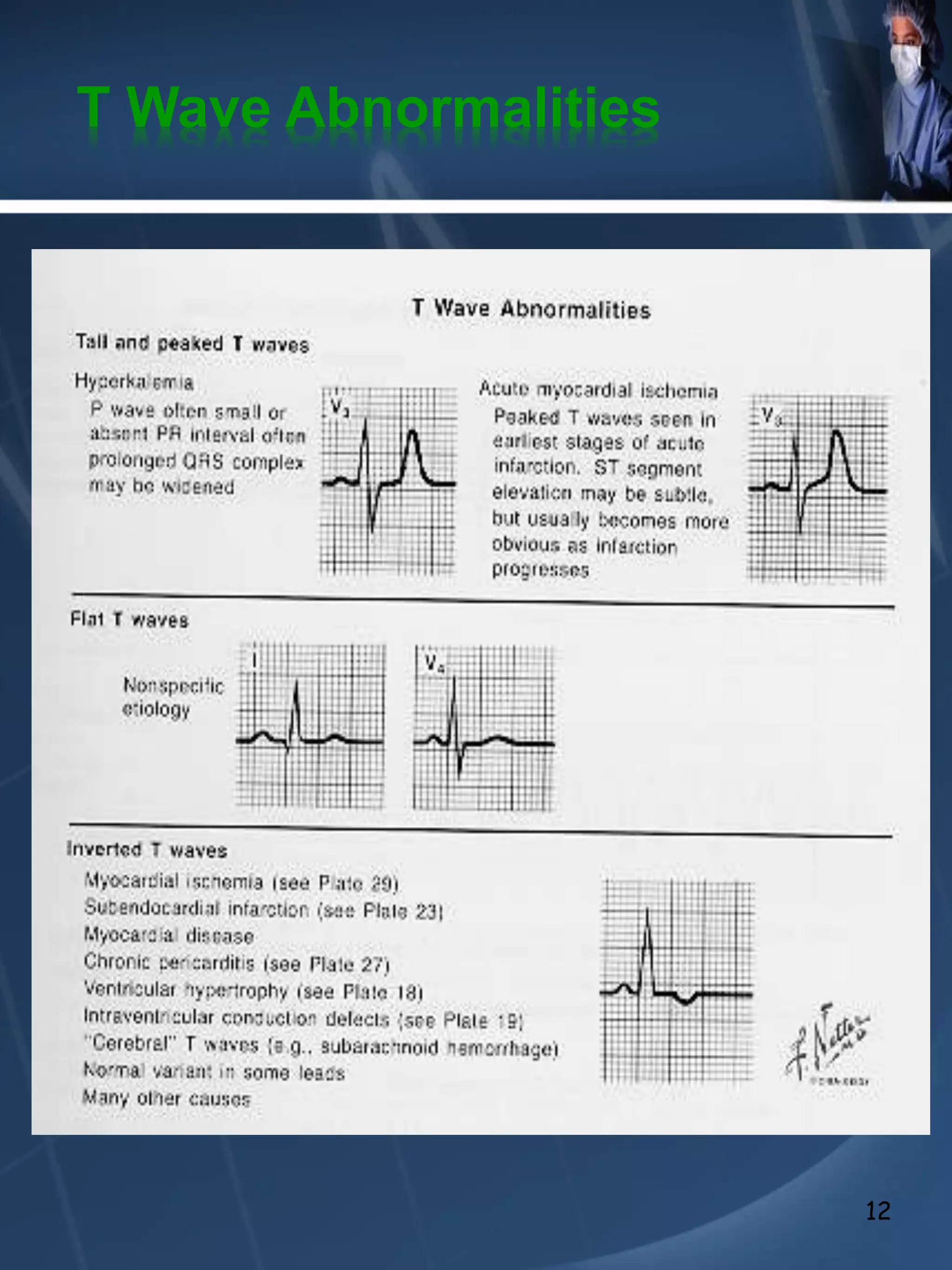 The Use of EKG to Detect Coronary Ischemia | PDF