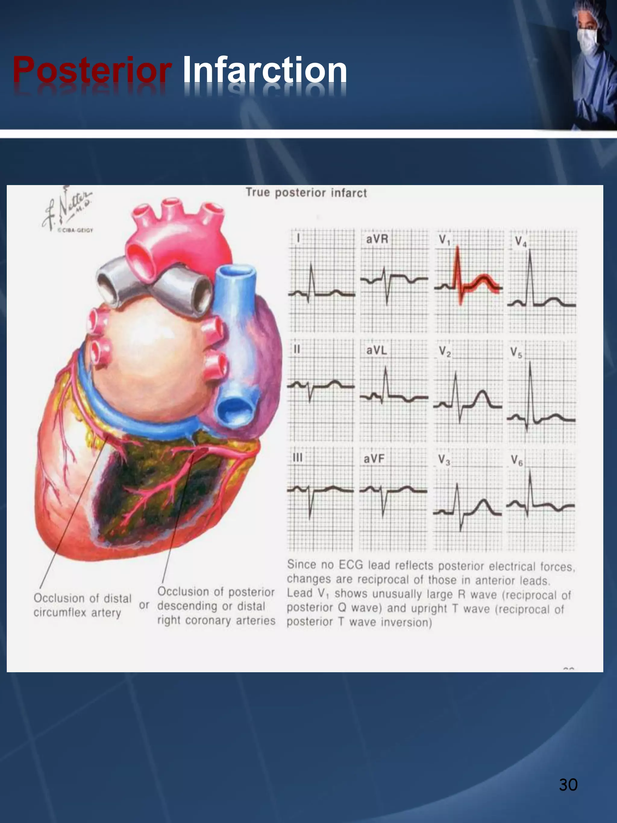 The Use of EKG to Detect Coronary Ischemia | PPTX