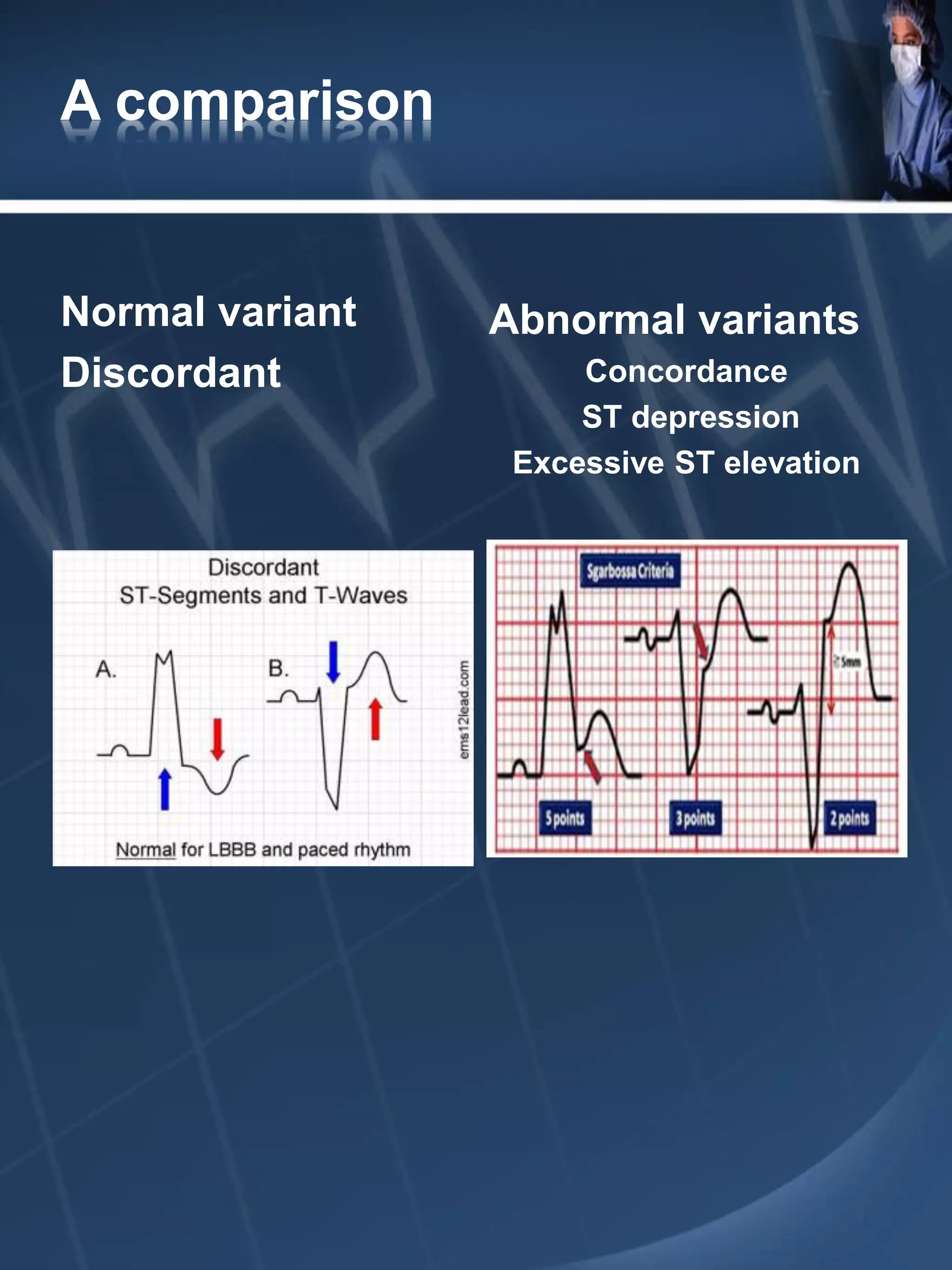 The Use of EKG to Detect Coronary Ischemia | PDF