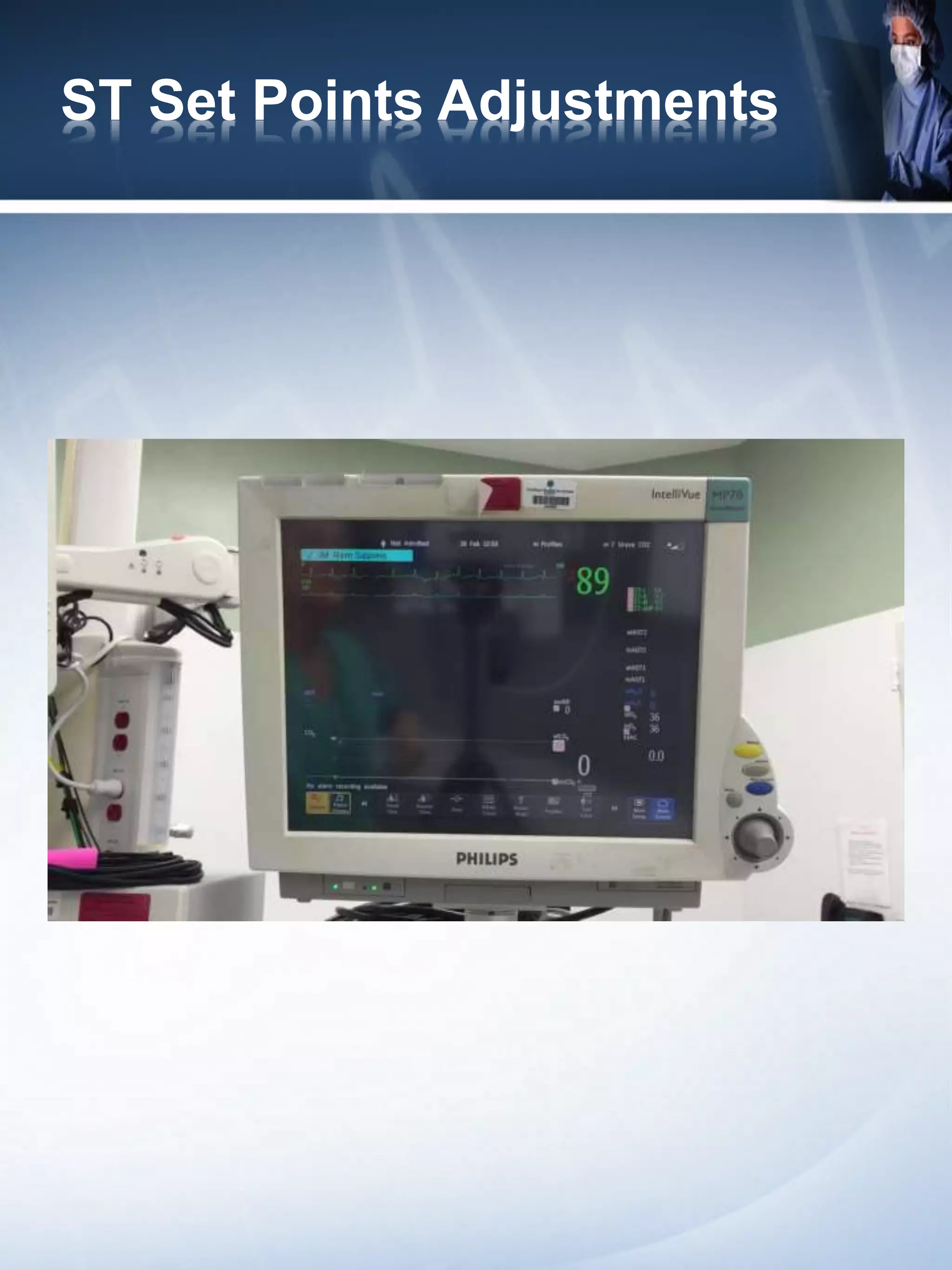 The Use of EKG to Detect Coronary Ischemia | PDF