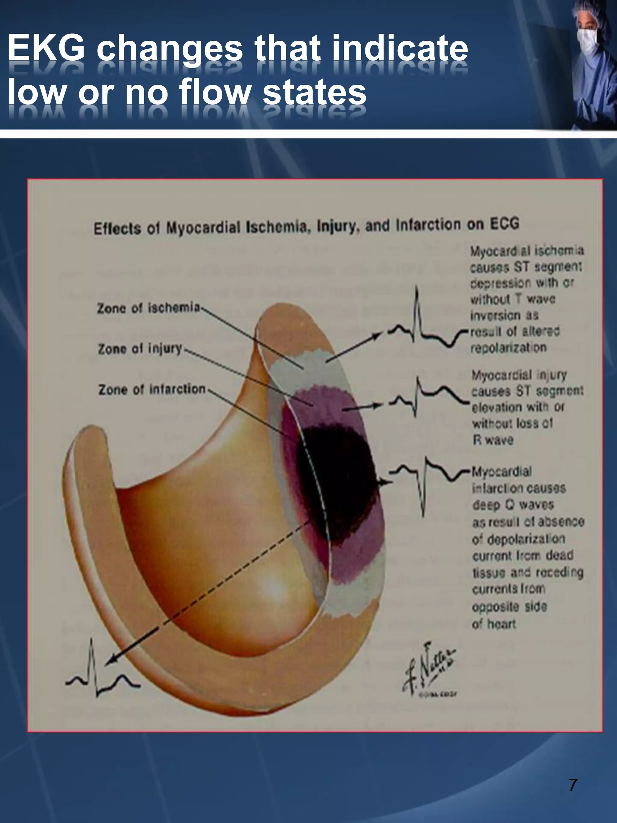 The Use of EKG to Detect Coronary Ischemia | PDF