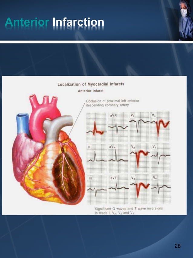 The Use of EKG to Detect Coronary Ischemia | PDF