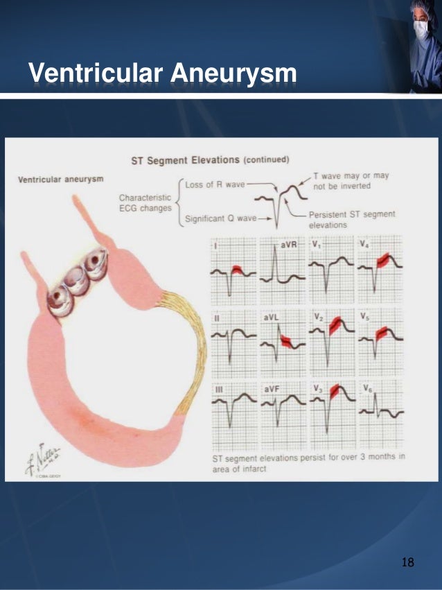 Lv Apical Aneurysm Anticoagulation | semashow.com