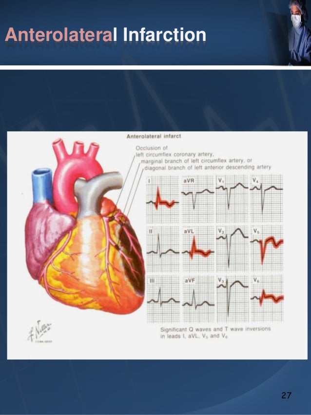 The Use of EKG to Detect Coronary Ischemia