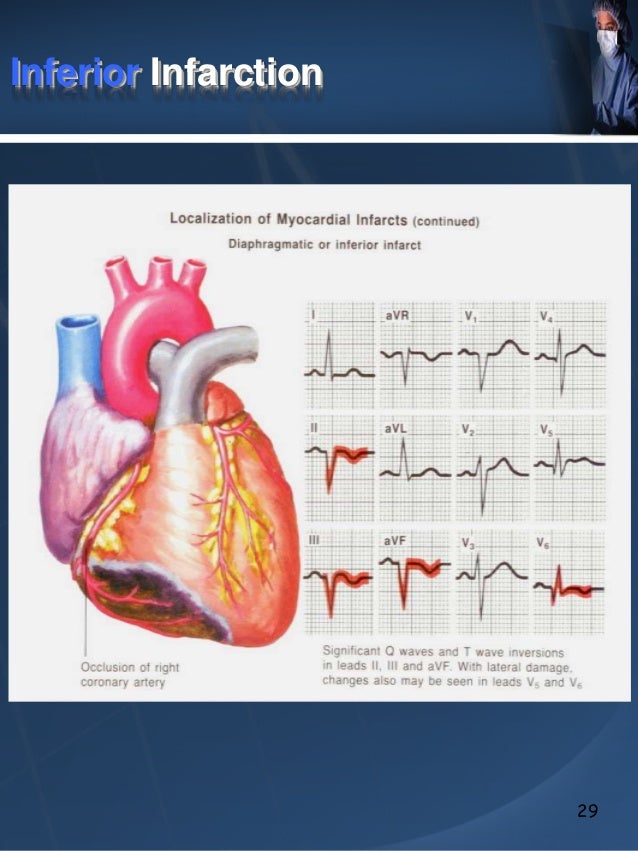 The Use of EKG to Detect Coronary Ischemia