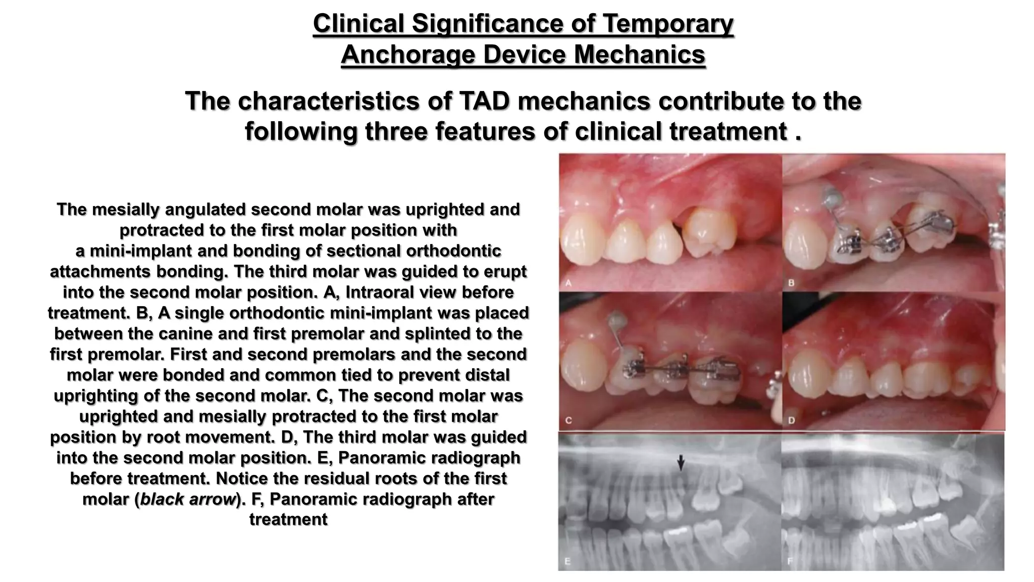 The use of microimplants in orthodontics | PPTX