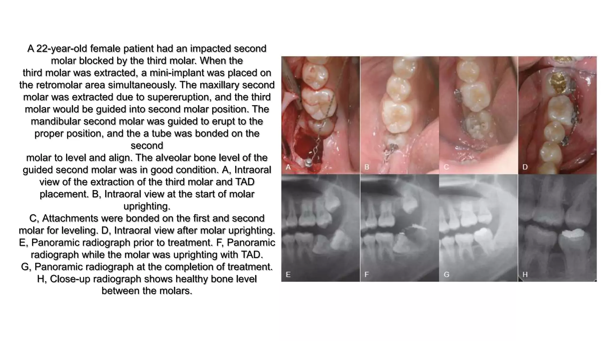 The use of microimplants in orthodontics | PPTX