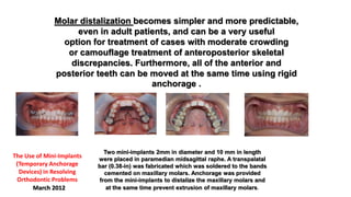 The use of microimplants in orthodontics | PPTX