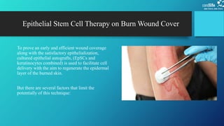 The use of stem cells in burnt wound treatment | PPT