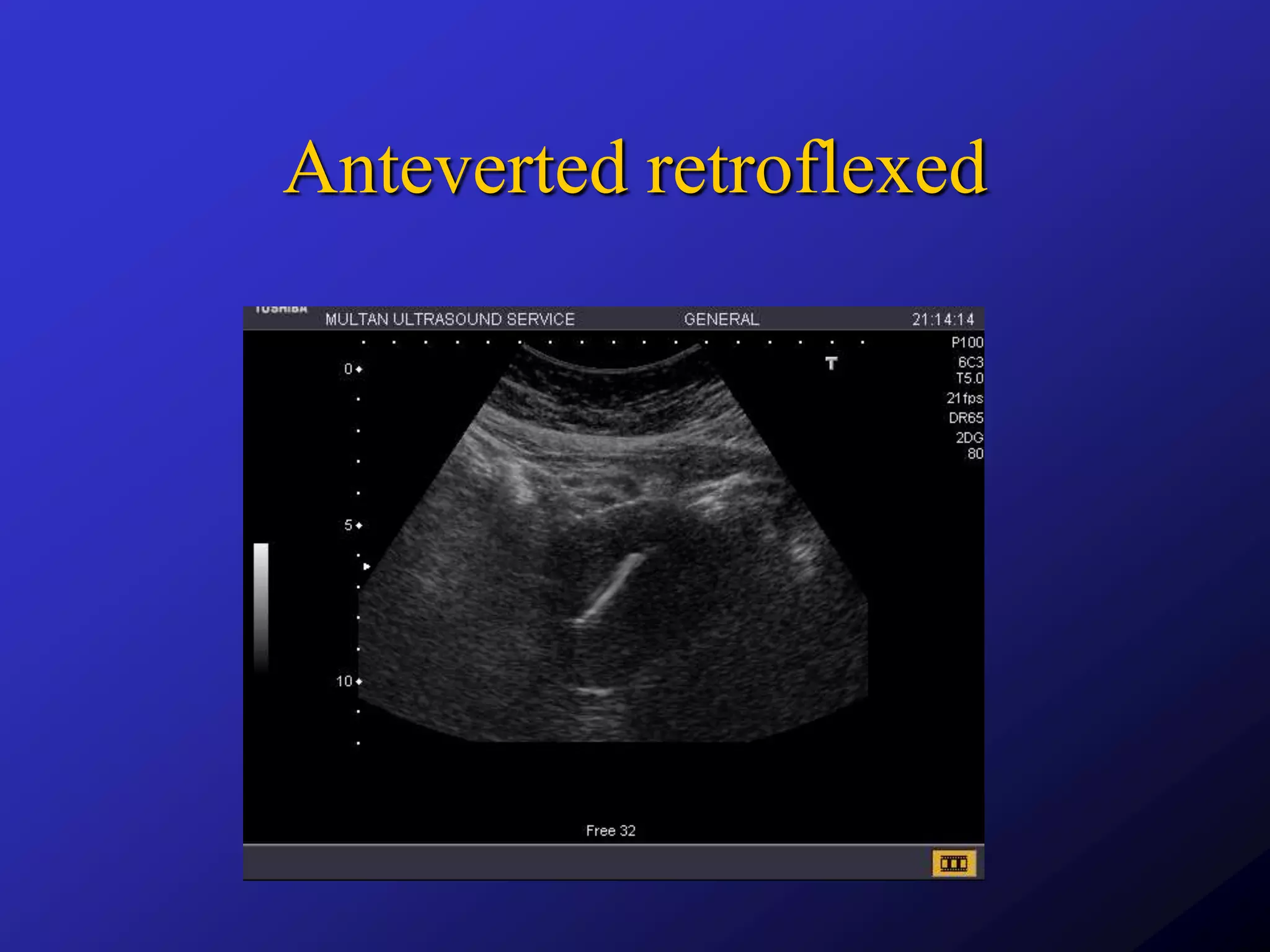 Ultrasound of uterus, part 1 | PPTX