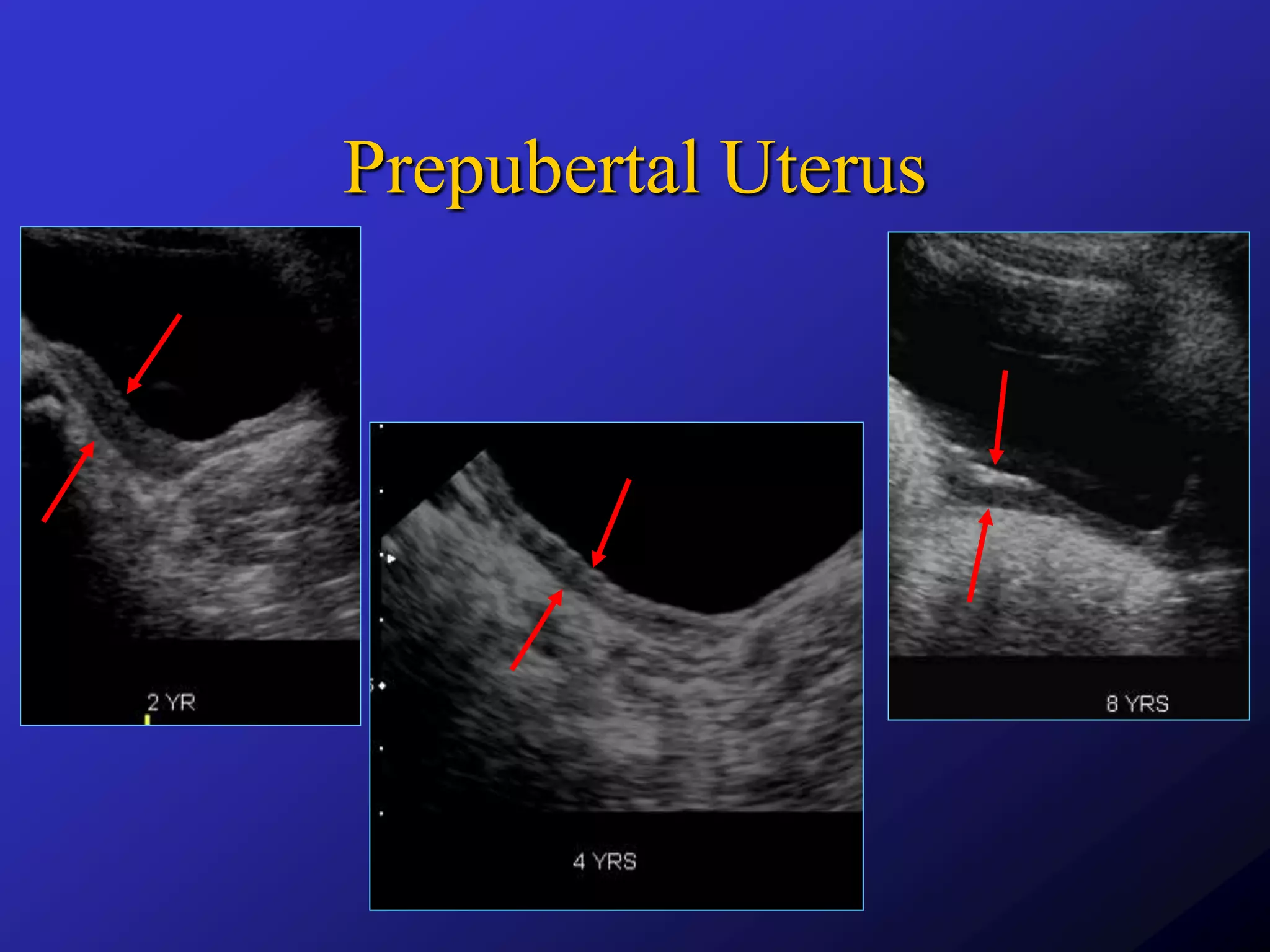 Ultrasound of uterus, part 1 | PPTX