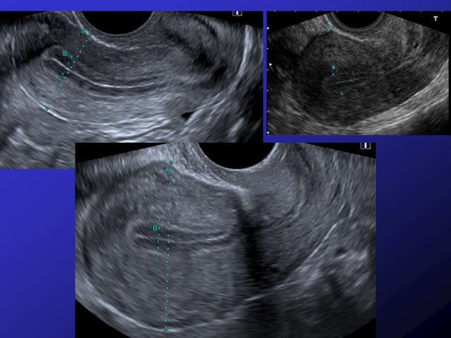 Ultrasound of uterus, part 1 | PPTX