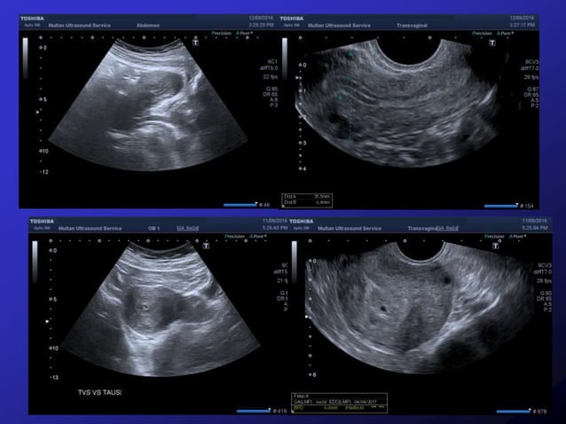 Ultrasound of uterus, part 1 | PPTX