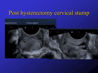 Ultrasound of uterus, part 1 | PPTX
