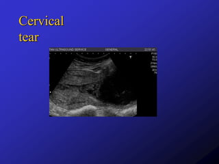Ultrasound of uterus, part 1 | PPTX