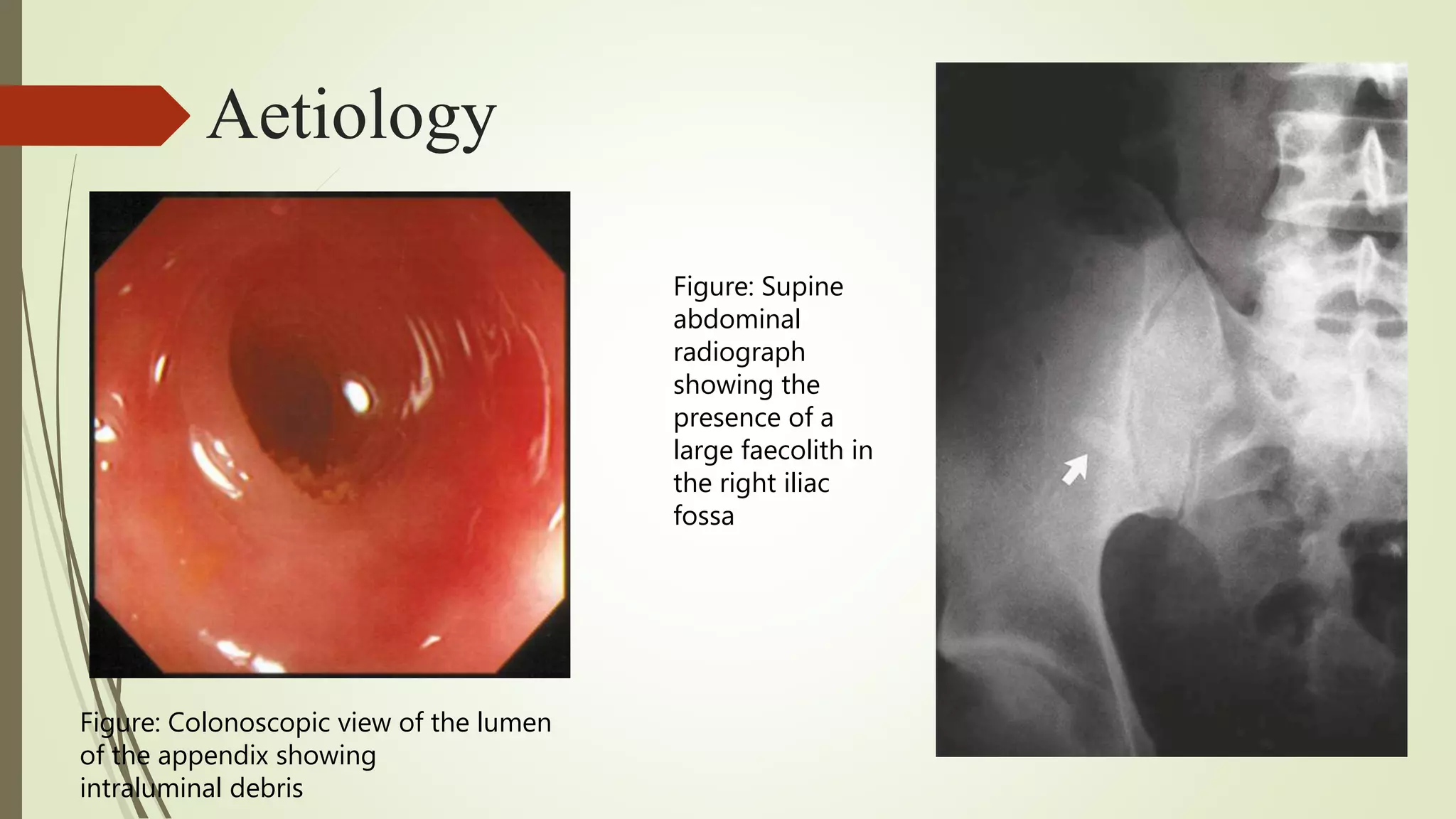 The Vermiform Appendix.pptx