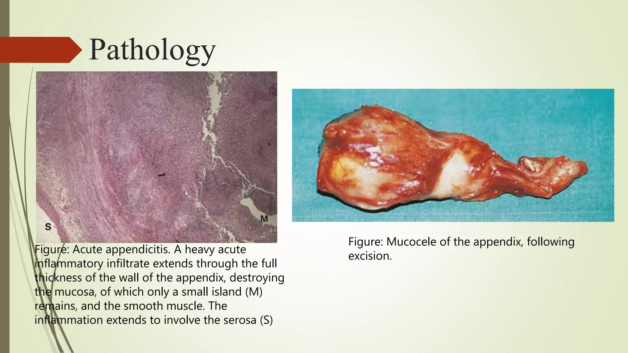The Vermiform Appendix.pptx