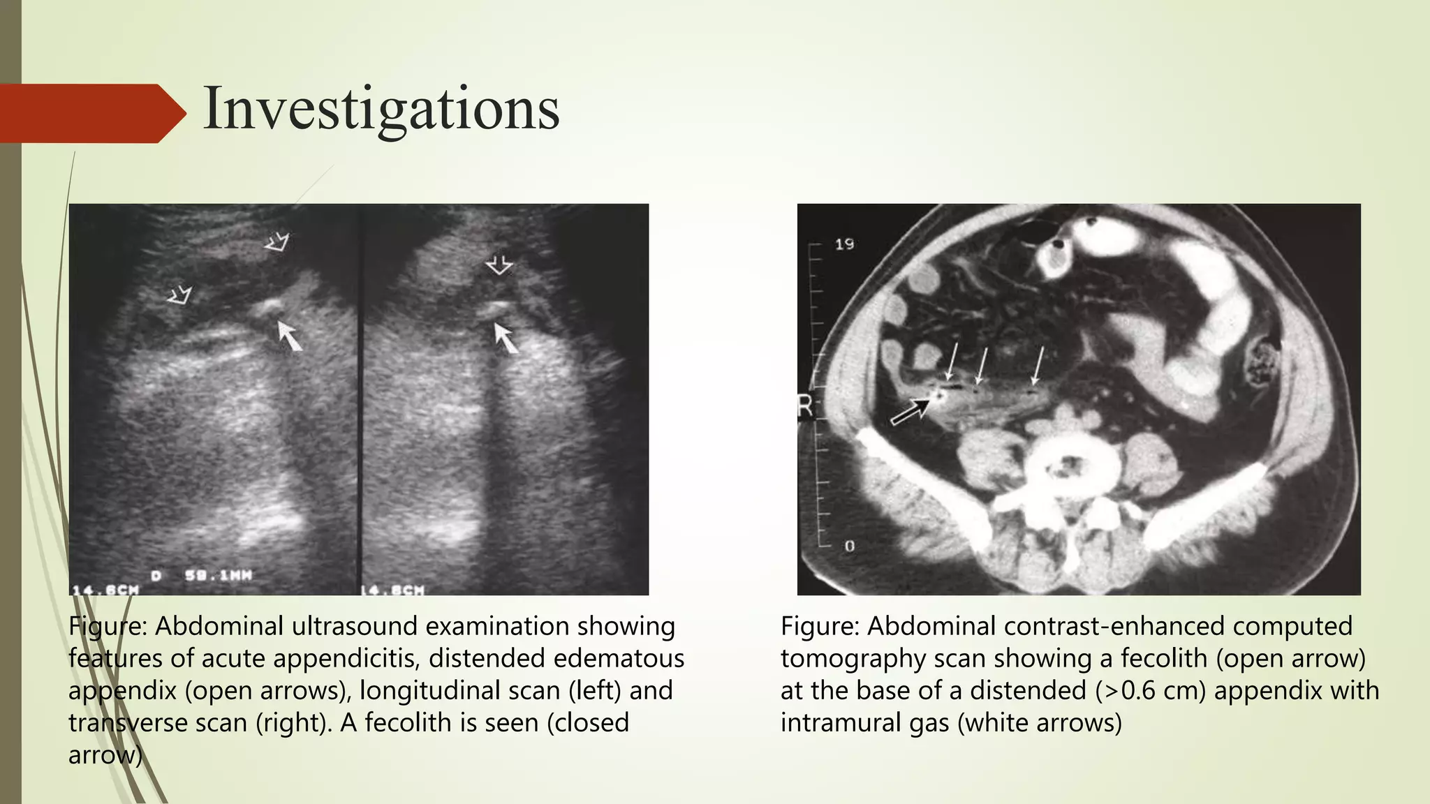 The Vermiform Appendix.pptx