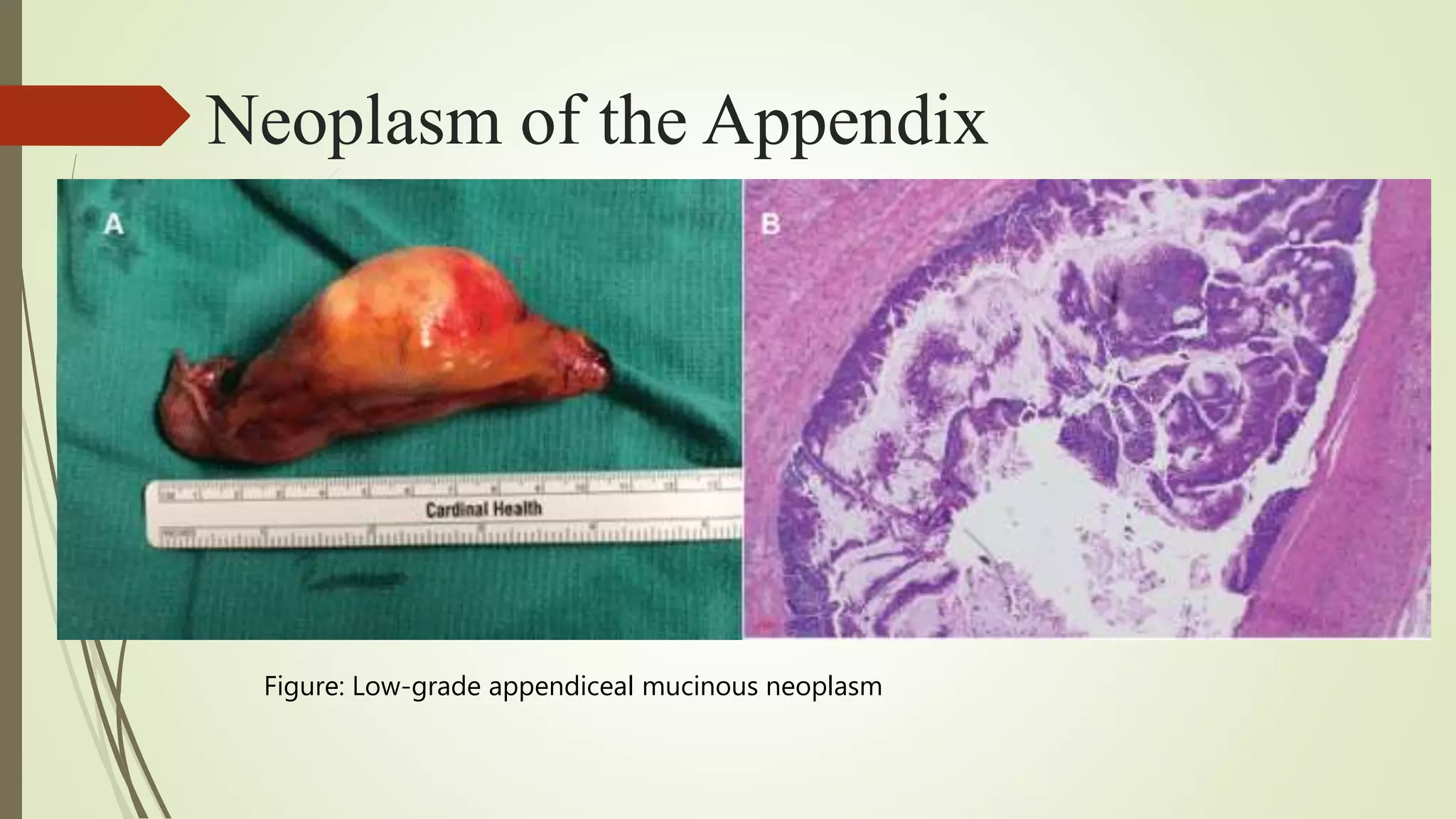 The Vermiform Appendix.pptx