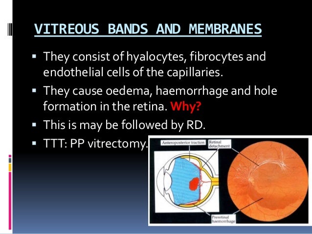The vitreous for undergraduate