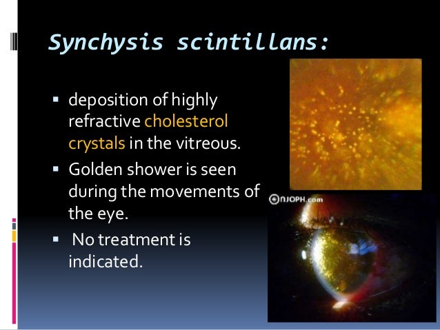 The vitreous for undergraduate