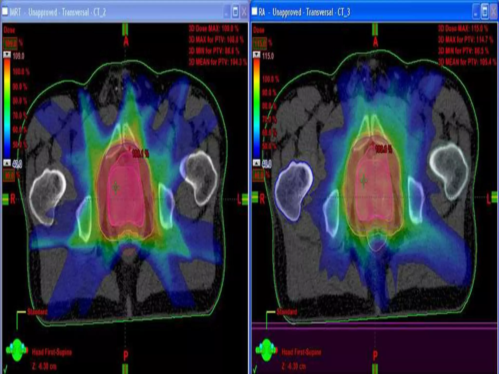 The vmat vs other recent radiotherapy techniques | PPTX