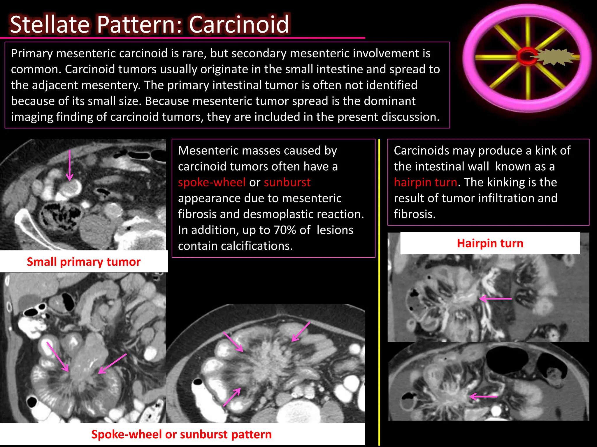 The Wheel of the Mesentery.pptx
