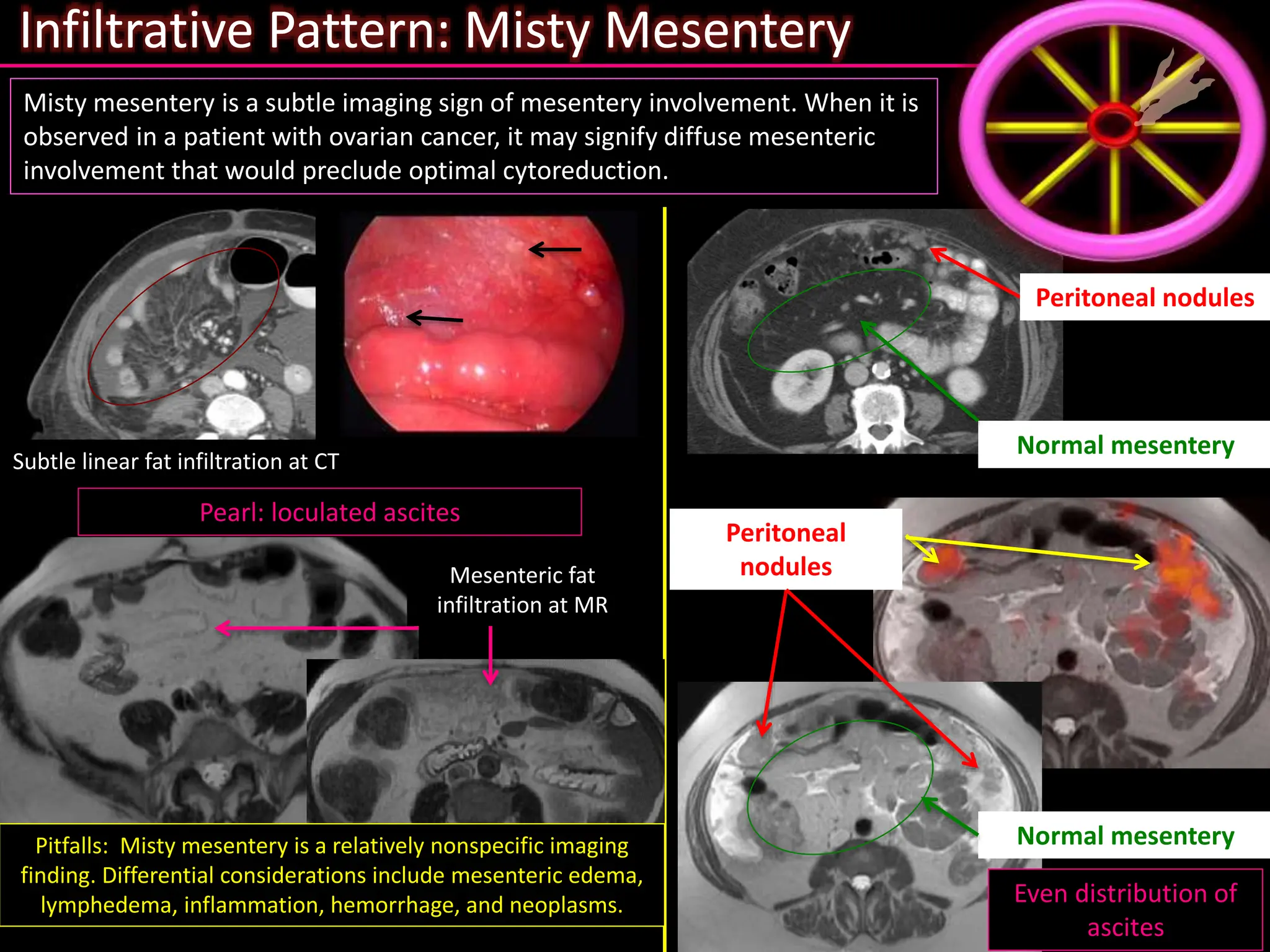 The Wheel of the Mesentery.pptx