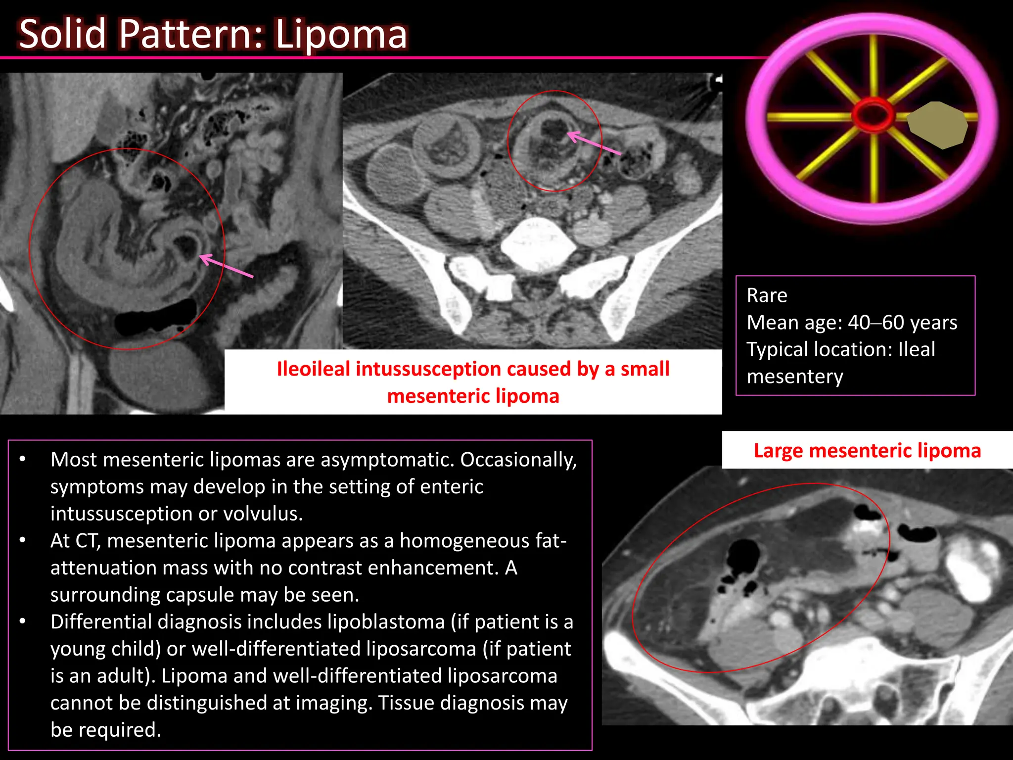 The Wheel of the Mesentery.pptx
